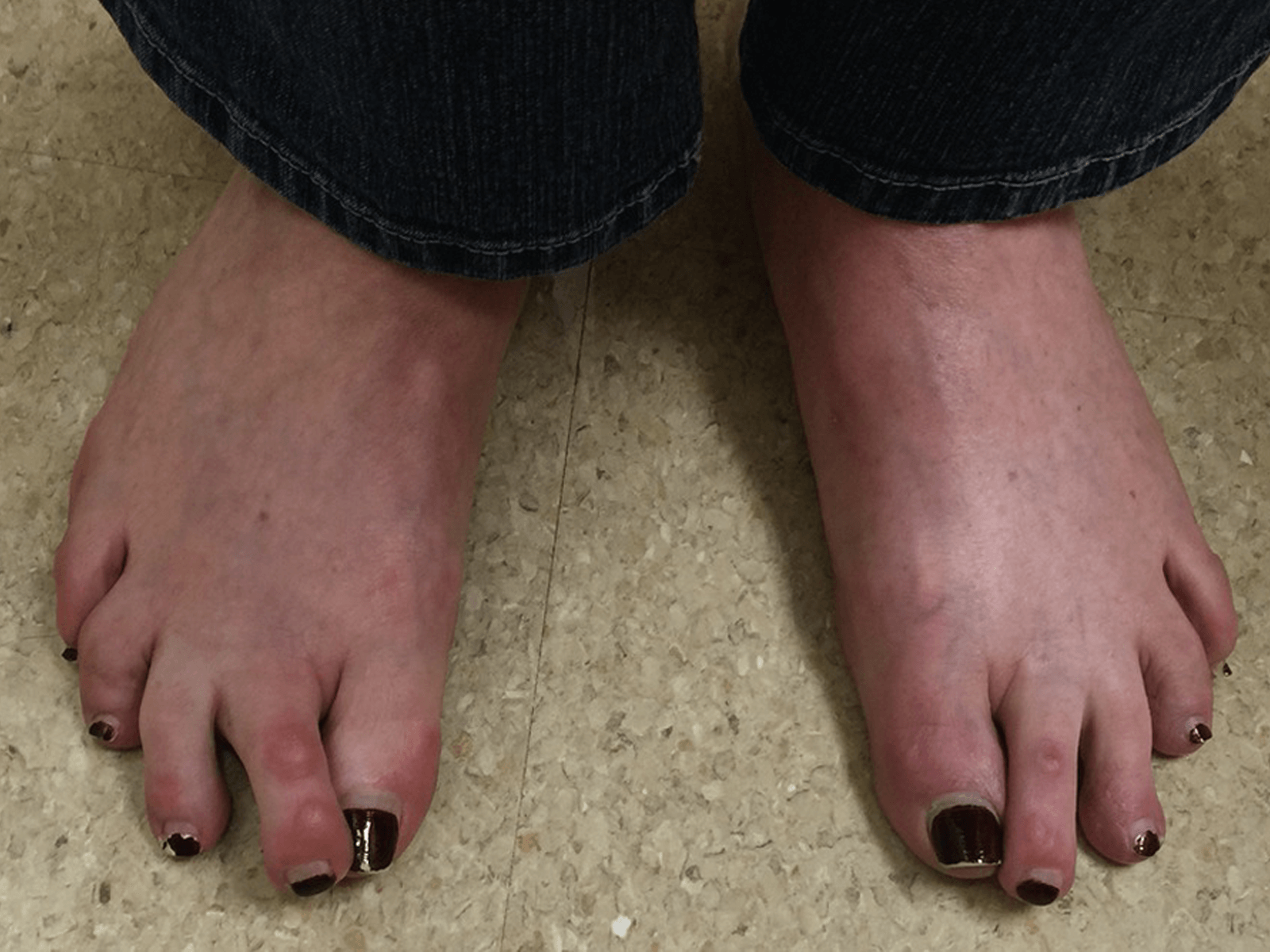 Cross Over Toe – Curafoot