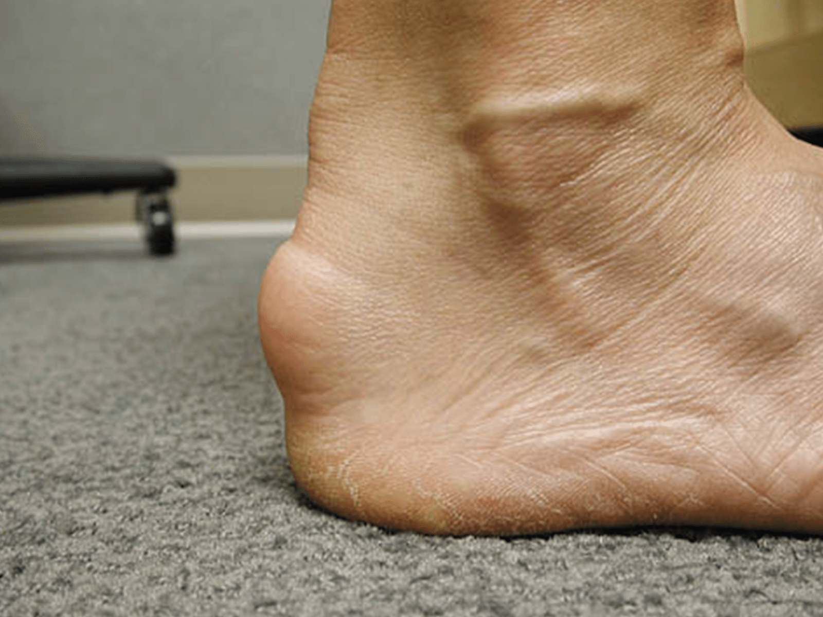 Retrocalcaneal Bursitis – Curafoot